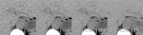 基于深度学习的低剂量ct去噪后处理算法研究 低剂量ct去噪技术 Csdn博客