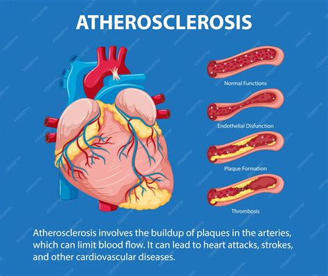 Premium Vector Science Education Human Anatomy And Atherosclerosis Infographic