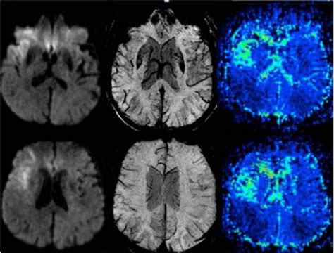 Susceptibility Diffusion Mismatch In Hyperacute Stroke Correlation With Perfusion Diffusion