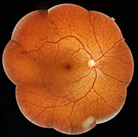 Congenital Hypertrophy Of Retinal Pigment Epithelium Retina Image Bank