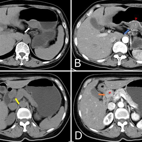 A B A Gist Located In The Lesser Curvature Of Gastric Middle Body