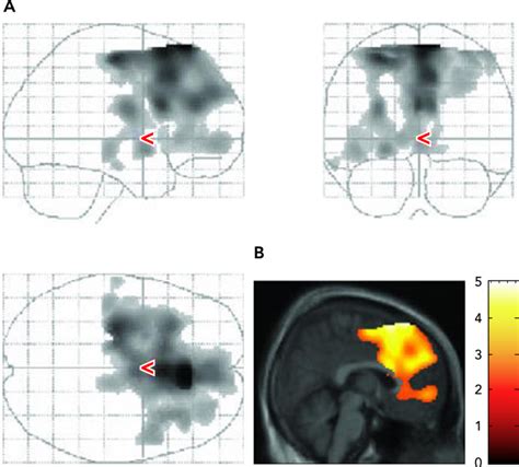 Voxel Based Analysis Testing Group By Intensity Level Interaction Download Scientific Diagram