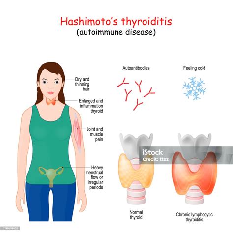 Tiroiditis Hashimoto Tiroiditis Limfosit Kronis Ilustrasi Stok Unduh