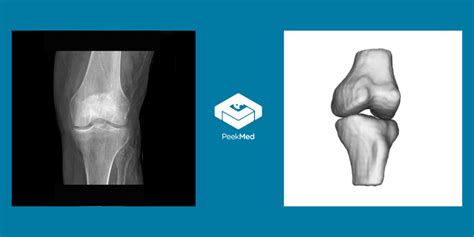 Ai Converting Of Radiographs To 3d Bone Models With Successful Results