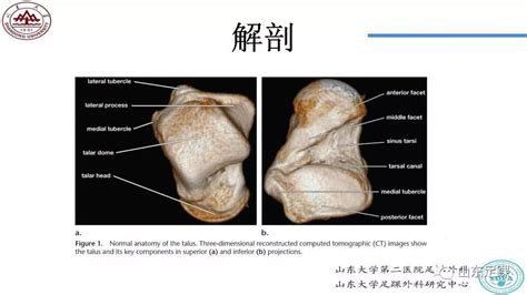 距骨骨折概述 好医术文章 好医术 赋能医生守护生命