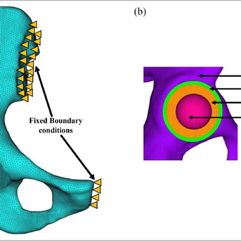 A Finite Element Model Of The Implanted Hemi Pelvis And B Download Scientific Diagram