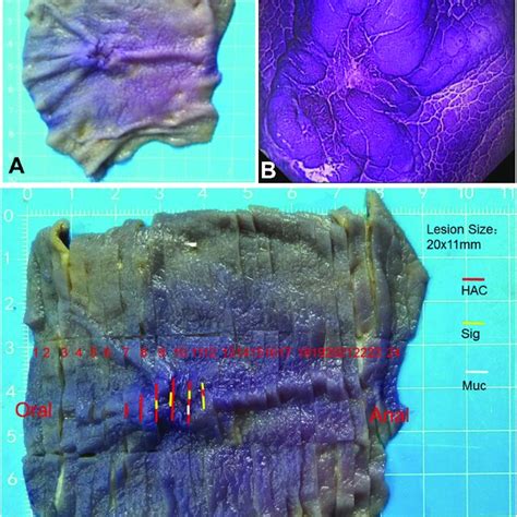Macroscopic Morphology Of The Resected Specimen A Macroscopic