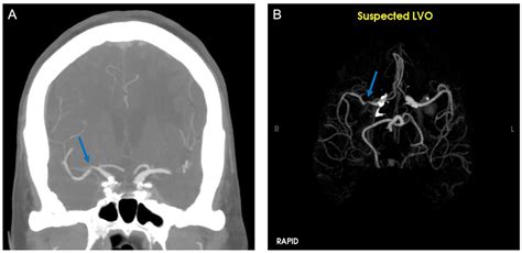 Automated Detection And Location Specification Of Large 56 Off