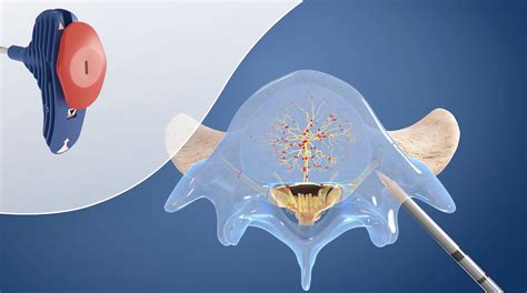Intracept Procedure