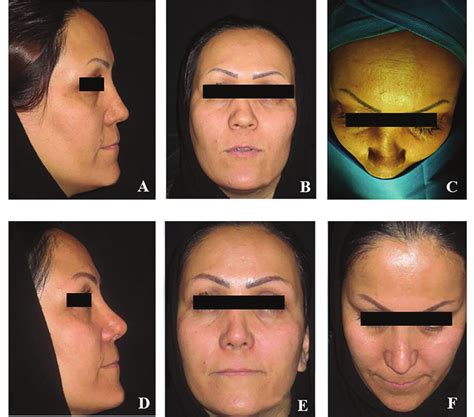 A 34 Year Old Woman With Crooked Nose Deformity Due To Nasal Fracture