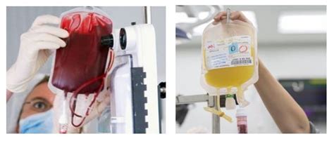 Transfuzija Krvi In Kultura Bolnišnična šola Ljubljana