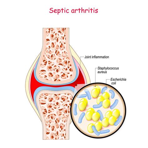 Septic Arthritis Orthopaedic Wellness Links