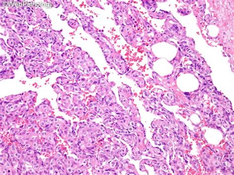 Primary Breast Angiosarcoma