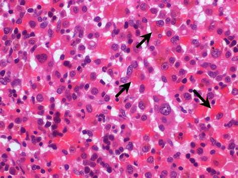 Haemophagocytic Histiocytic Sarcoma Case Study Cytopath