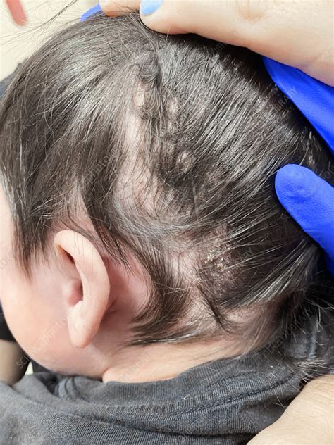 Ringworm Of The Scalp Stock Image C060 5540 Science Photo Library