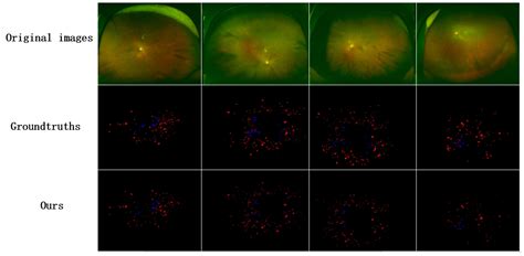 Lightweight Frequency Recalibration Network For Diabetic Retinopathy Multi Lesion Segmentation