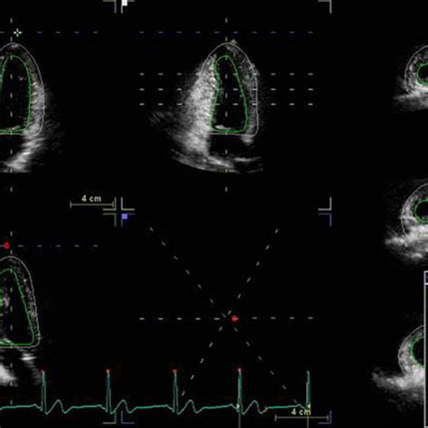 Automated Detection Of The Endocardium And Epicardial Border Throughout