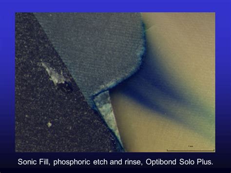 Bulkfill Polymerization Shrinkage Is The Enemy Docs Education