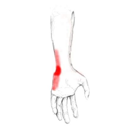 Flexor Carpi Ulnaris Pain Trigger Points