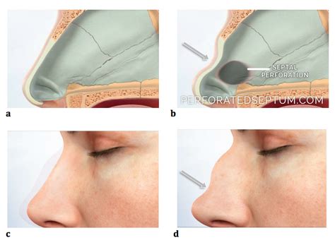 Perforated Septum Dr Hamilton Surgical Repair Of A Hole In The Septum