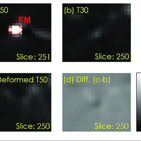 Sample Outlier Results Deformed By The Fast Demons Algorithm Algorithm
