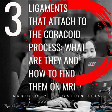 3 Ligaments Attached To The Coracoid Process What Are They And How To Find Them On Mri Video