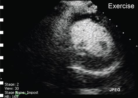 Stress Echocardiogram With Contrast Parasternal Mid Left Ventricular