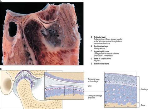 Infratemporal And Pterygopalatine Fossae And Temporomandibular Joint