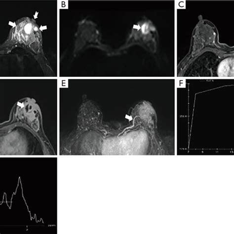 A 29 Year Old Woman With Histologically Proven Plasma Cell Mastitis