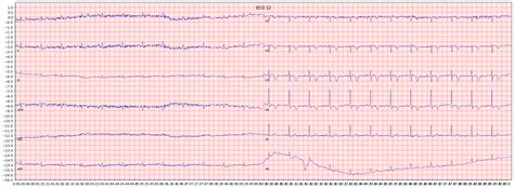 Examples Of Subendocardial Injury In Anteroseptal Leads INJAS ECG Library