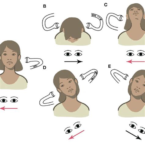 Diagnostic Algorithm For Lsc Bppv Minimum Stimulus Strategy Mss Download Scientific