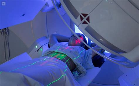 IMRT Radioterapia de Intensidad Modulada: qué es, síntomas y ...