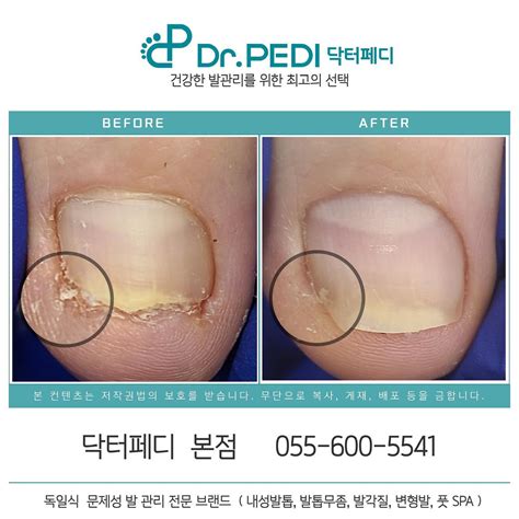 Nailit City7 닥터페디본점내성발톱 아파서 짧게 자르지 마시고 정확한 상담과 관리를 통해