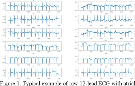 Figure 1 From Automatic Detection And Classification Of 12 Lead Ecgs