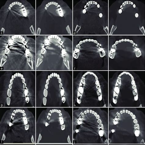A L From Left To Right Dental Cbct Image And Its Artifact Reduced Download Scientific