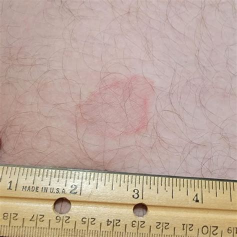 Help Id Skin Lesion Rash That Has Appeared Suddenly R Askdocs