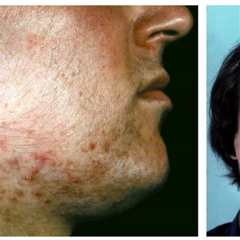 Acne Hirsutism And Androgenetic Alopecia Of Female Pattern In Pcos