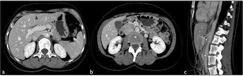 Nutcracker Syndrome Ncbi At Glenn Joshua Blog
