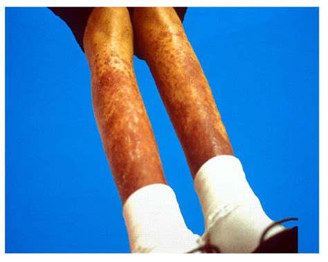 Skin Rash In A 12 Year Old Female With Sarcoidosis Both Lower