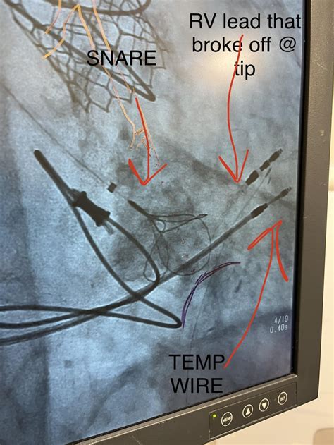 Laser Lead Extraction Rcardiology