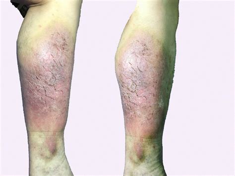 Хөлийн судас өргөсөн бүдүүрэх Судасны Оношилгоо Эмчилгээ Facebook