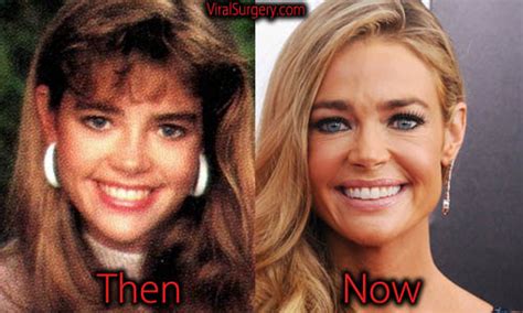 Denise Richards Plastic Surgery Before And After Boob Job Pictures