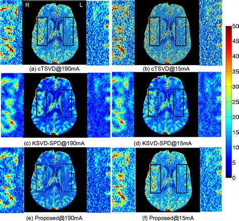 Figure From Towards Robust Deconvolution Of Low Dose Perfusion CT Sparse Perfusion