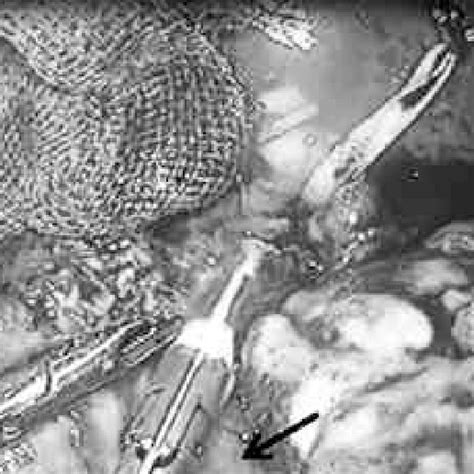 A View Of Kocherization Arrow Shows The Descending Duodenum And The Download Scientific