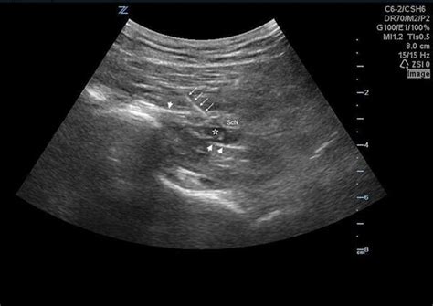 Sciatic Nerve Injection Wikism Sports Medicine Wiki