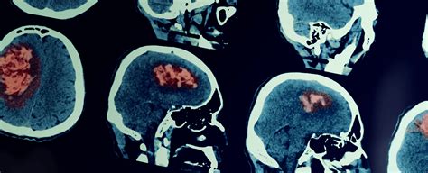 Short Tandem Repeat Expansion Genotyping In Wf Human Variation Epi2me Blog
