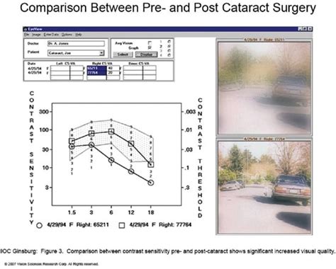 Contrast Sensitivity Testing 20 20 And More Ophthalmology Management