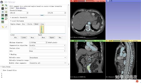 3d Slicer 重建腹主动脉及髂动脉 知乎