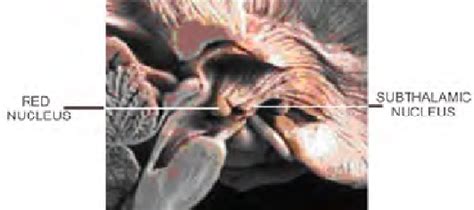 Red Nucleus And Subthalamic Nucleus The Position Of The Red Nucleus Is Download Scientific