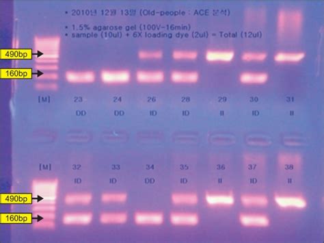 Detection Of I D Polymorphism Of The Angiotensin Converting Enzyme Gene
